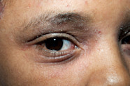 Dry Red Itchy Skin Under Eyes Infoupdate Dry Red Itchy Skin Under Eyes Infoupdate
