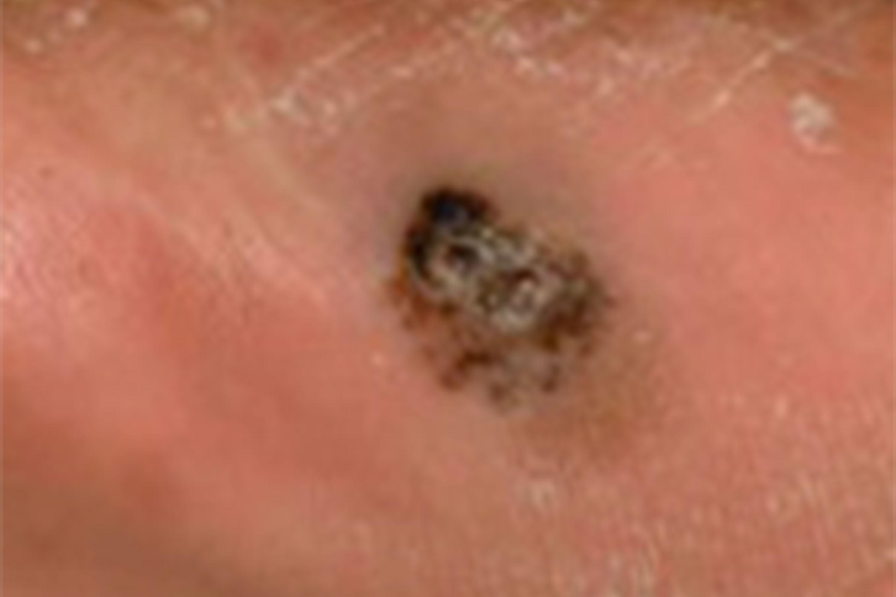Melanoma on Dark or Black Skin: How to Identify It, Types and More