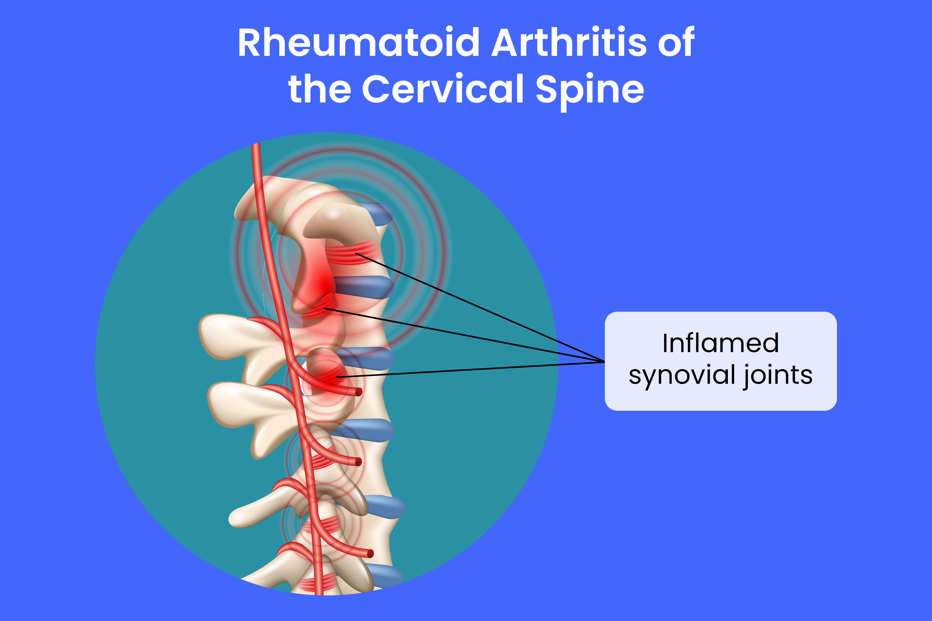 Cervical Spine Tenderness