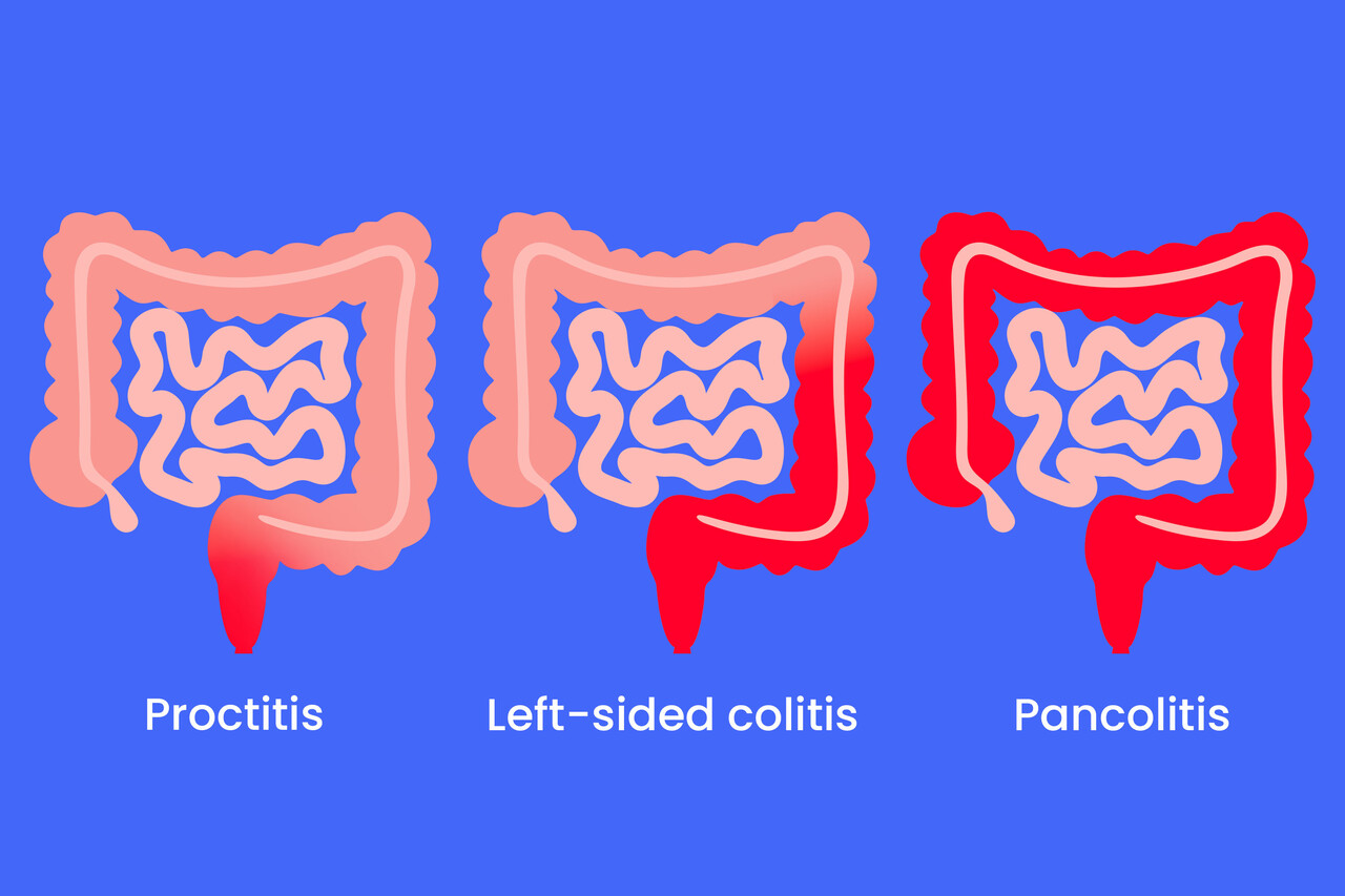 Pancolitis: Symptoms, Causes, & Treatment