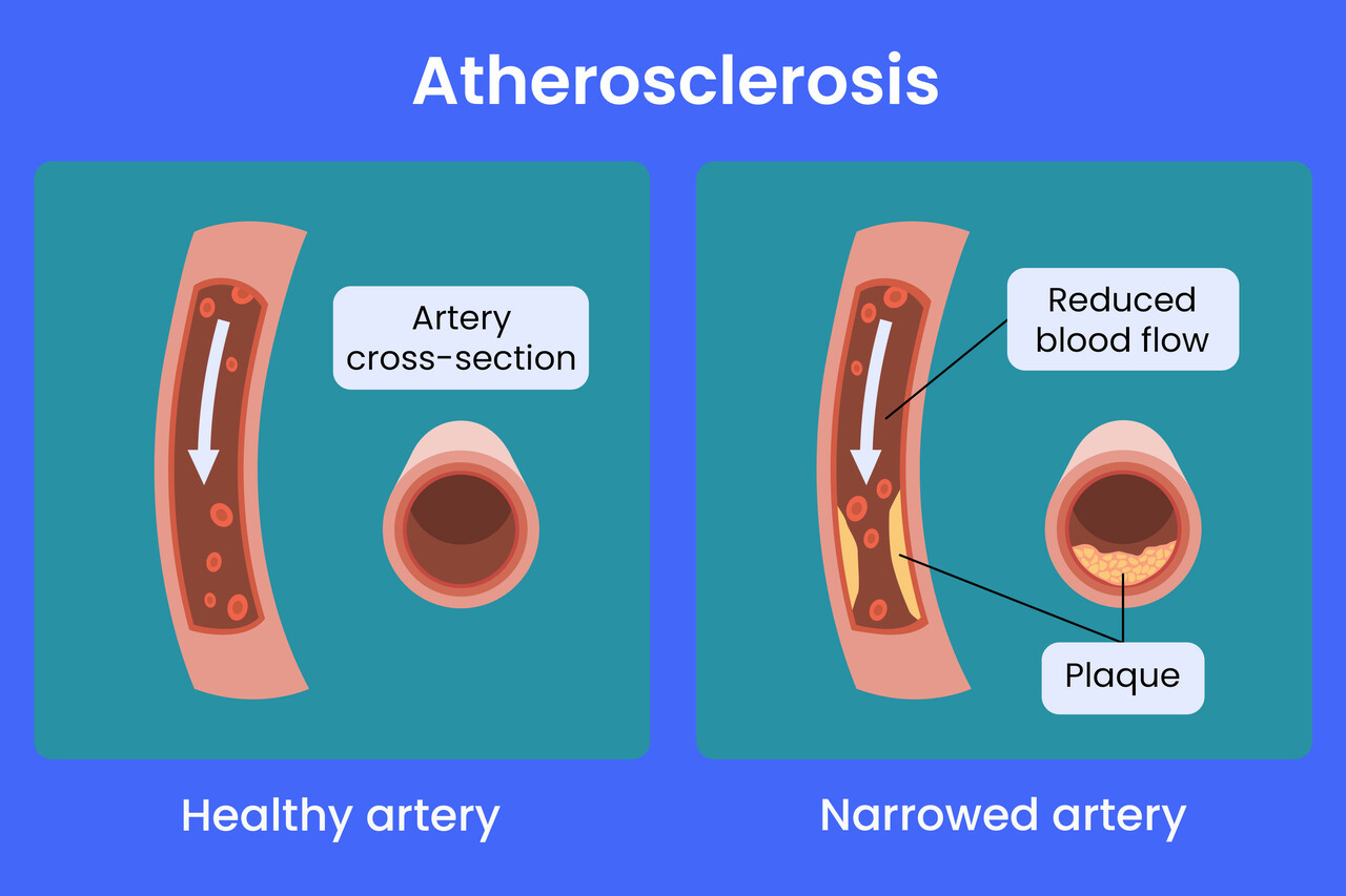 Cholesterol In Arteries