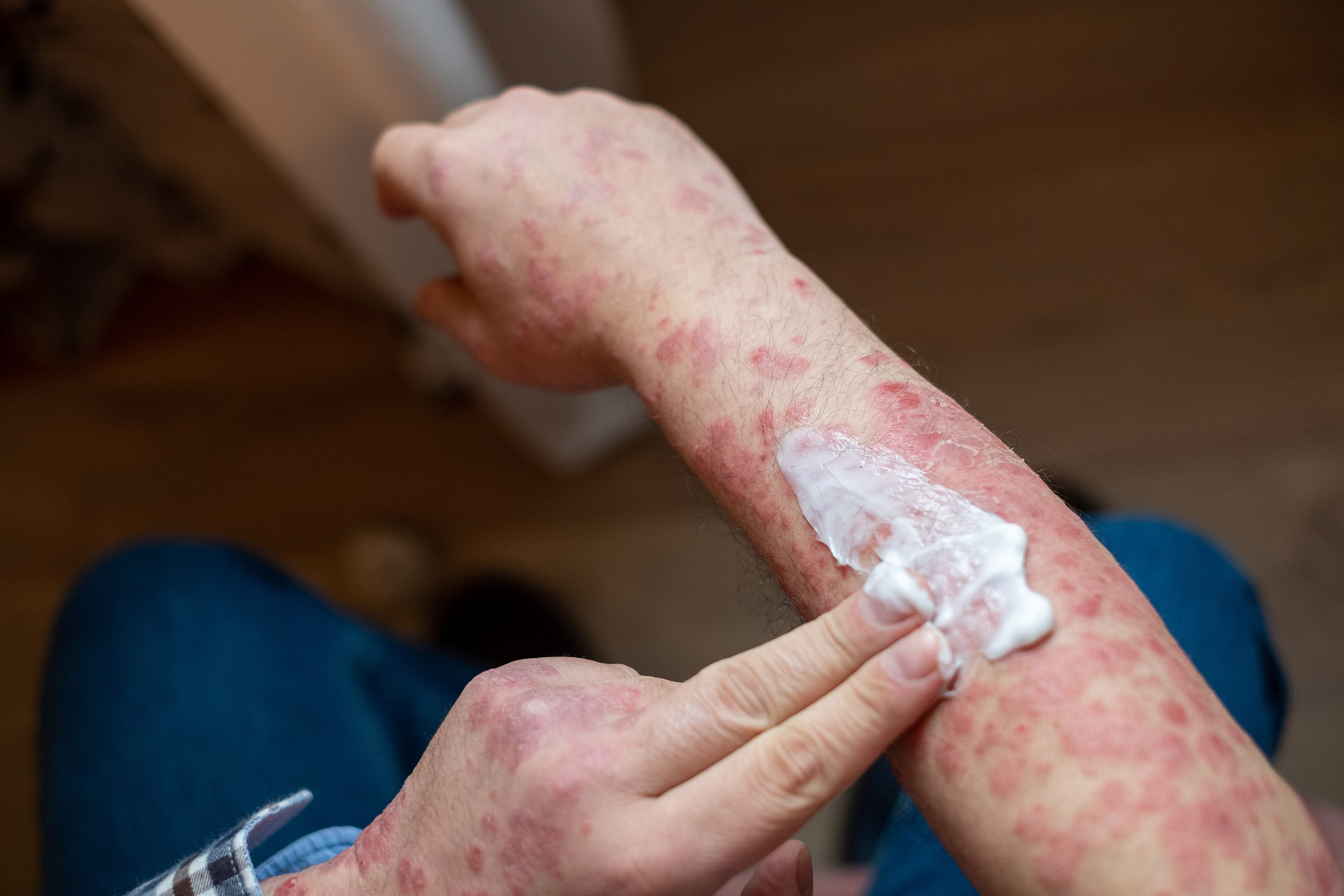 How Does PsA Affect the Skin?