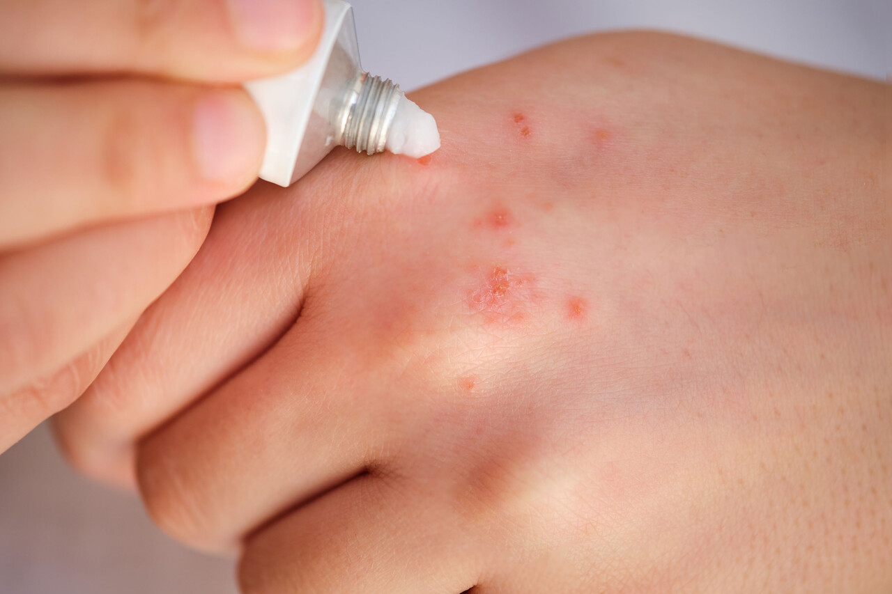 Corticosteroids for Psoriasis: Treatment For Your Psoriasis