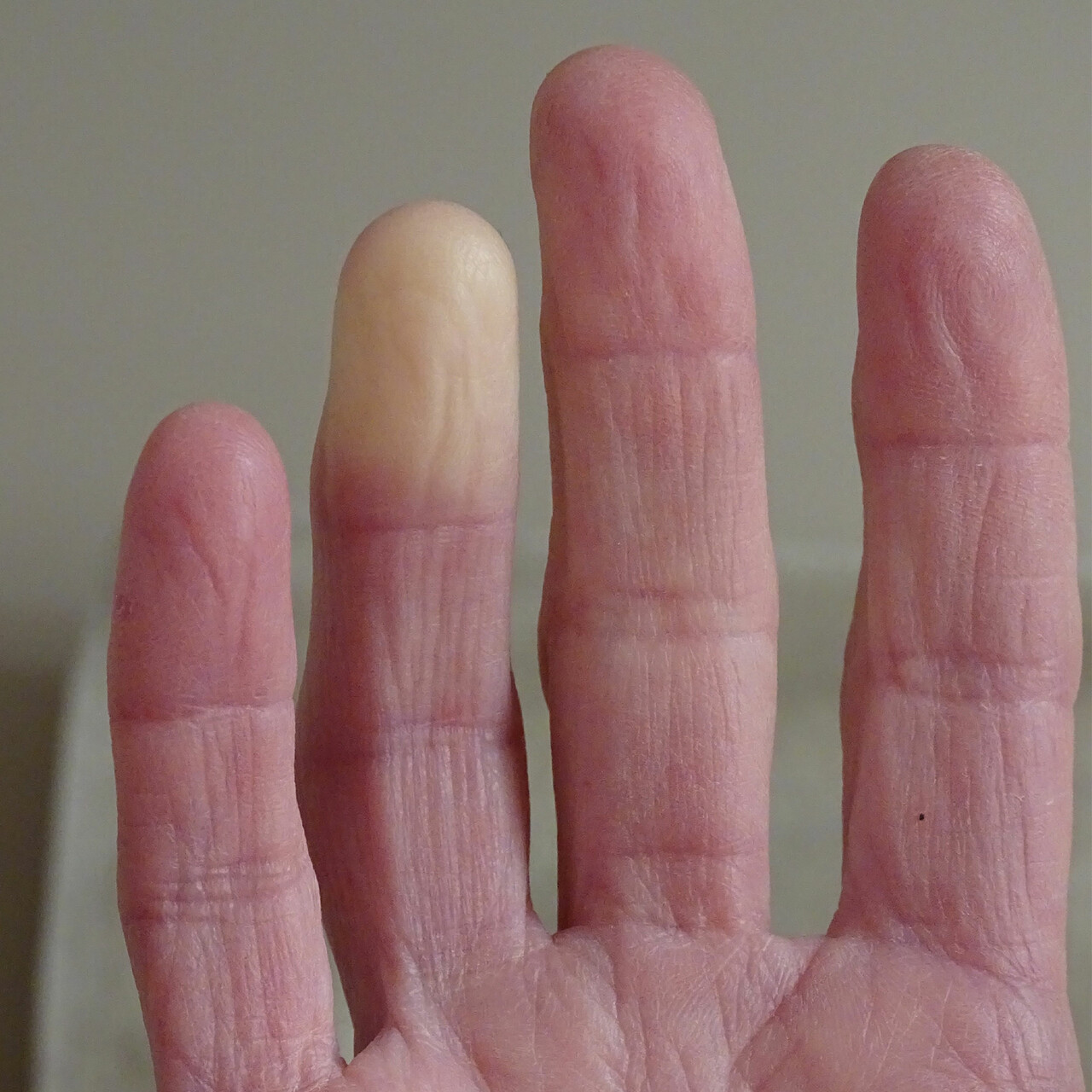 7 Ways Lupus Affects Your Body