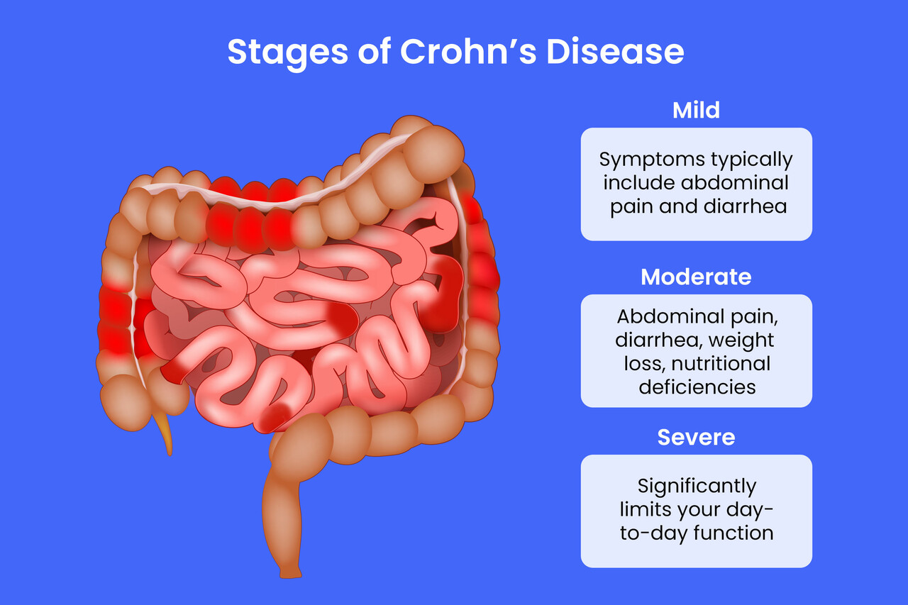 The Stages of Crohn’s Disease: Mild, Moderate and Severe