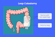 Loop Ileostomy Closure Loop Ileostomy Closure