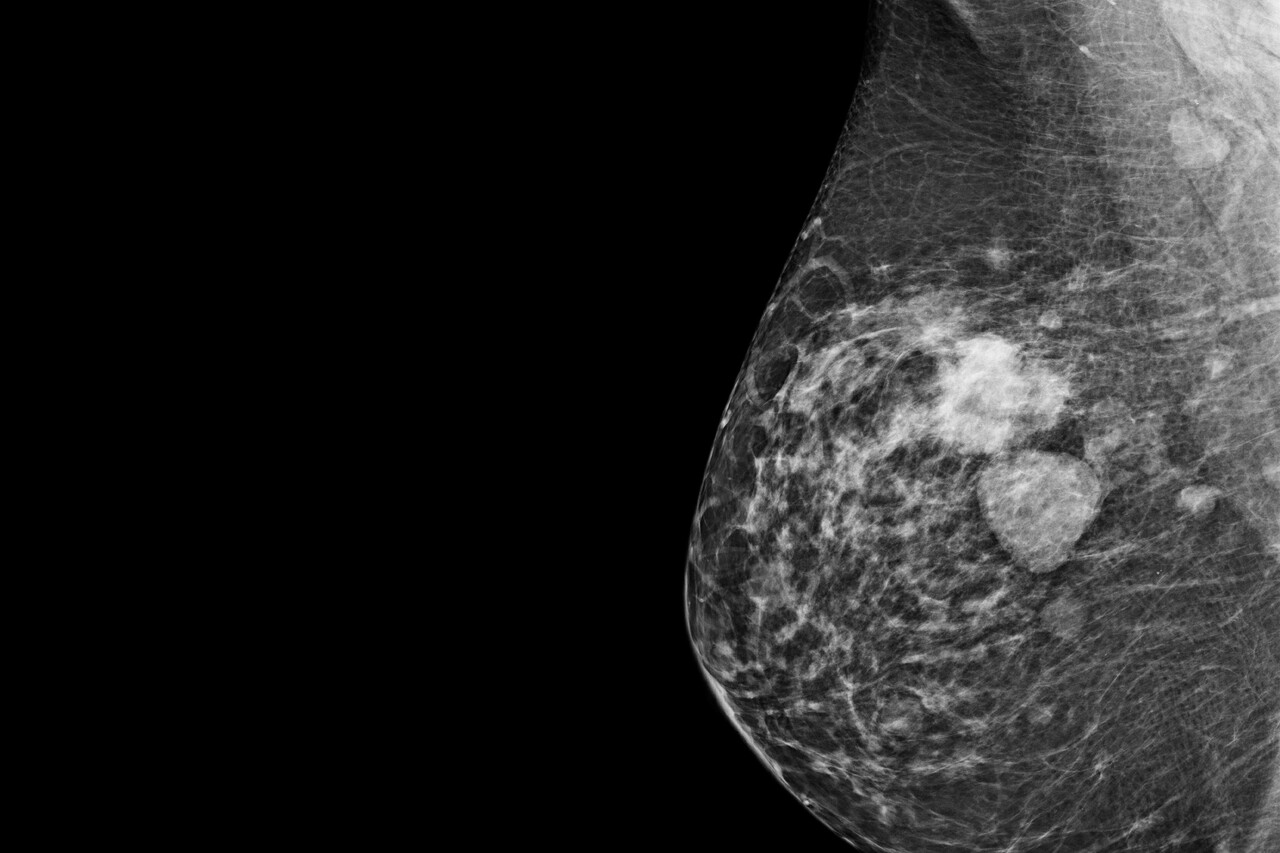 Multifocal Breast Cancer: Stages, Diagnosis and Treatment