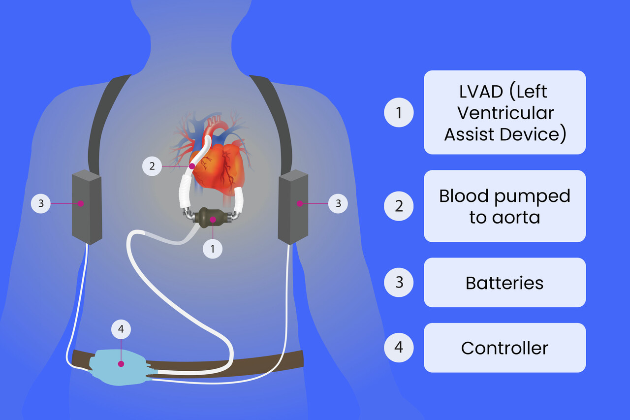 LVAD (Left Ventricular Assist Devices) Pump for Heart Failure