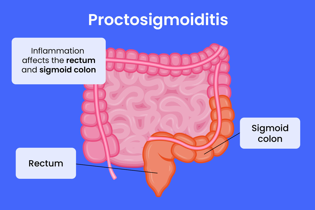 Proctosigmoiditis: Symptoms, Causes, Treatment and More