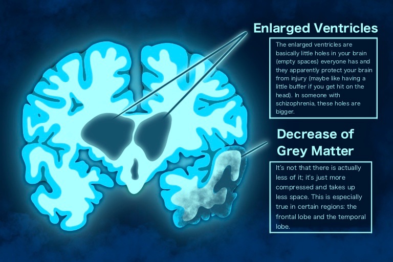 schizophrenia   mind