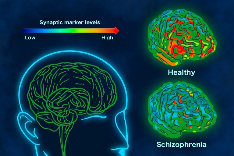 schizophrenia   mind