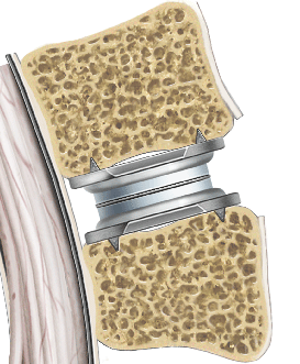 Artificial Disc Replacement