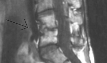 Discitis Is a Spinal Disc Infection and Inflammation