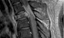 Multiple Myeloma of the Spine