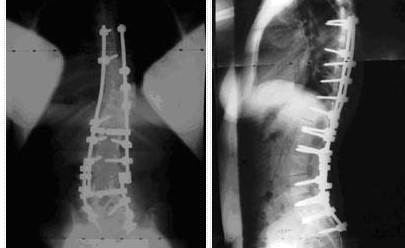 Flatback Syndrome: Spine Surgery to Correct Spinal Alignment