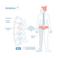 Sciatica Symptoms Sciatica Symptoms