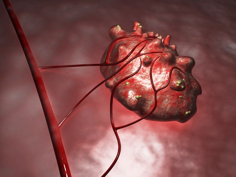 Types of Lumbar Spine Cysts