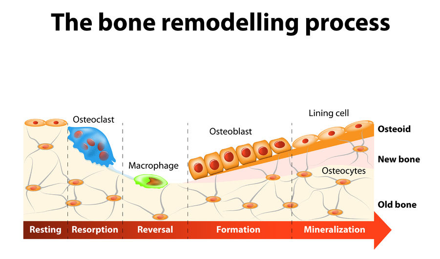 Bone Growth Stimulation After Neck or Back Spinal Fusion