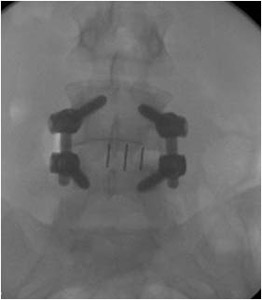 Stabilization in Spine Surgery