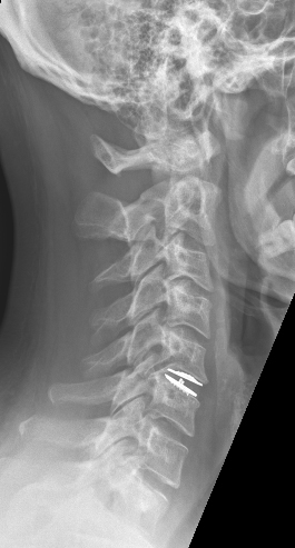 Cervical Disc Replacement for Neck or Arm Pain