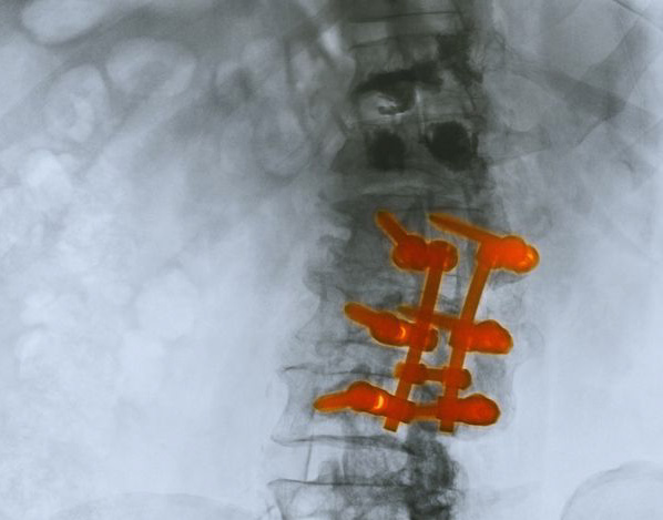 Pseudoarthrosis (Failed Fusion)