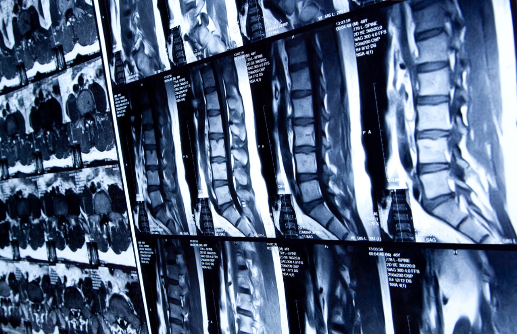 Spondylosis Center - Spinal Osteoarthritis - Symptoms Exercises Treatments
