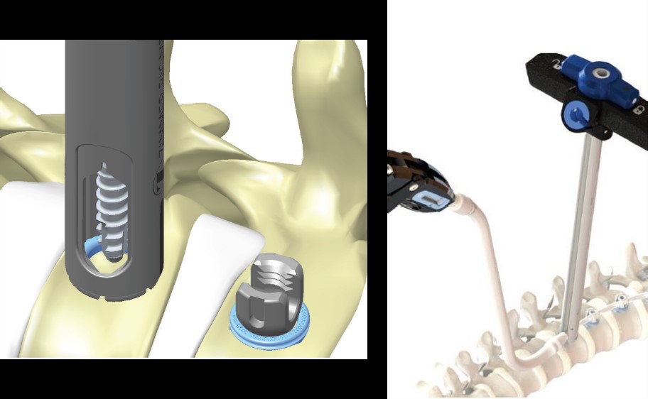Two Scoliosis Surgery Options that Aren’t Fusion