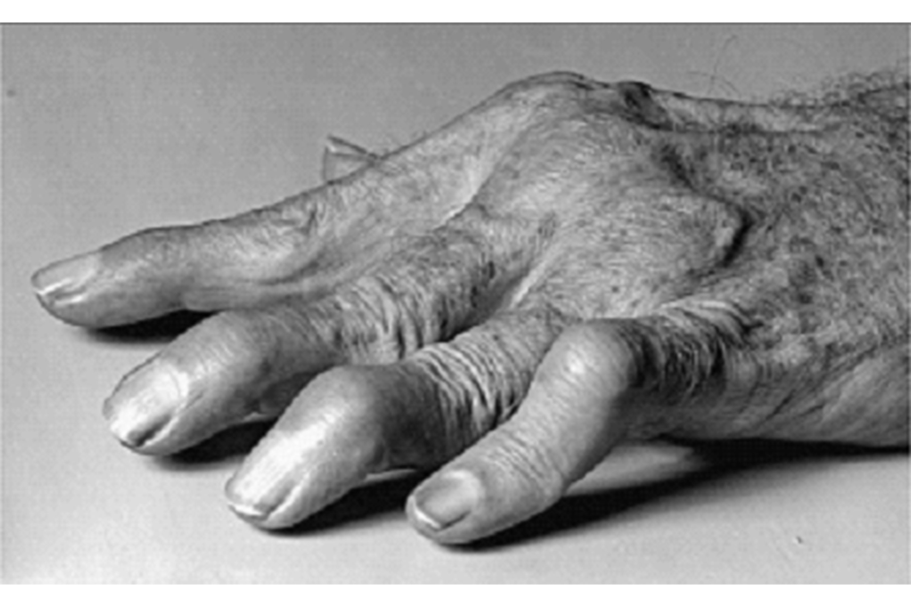 Rheumatoid Arthritis Hands: Symptoms, Causes and Treatment