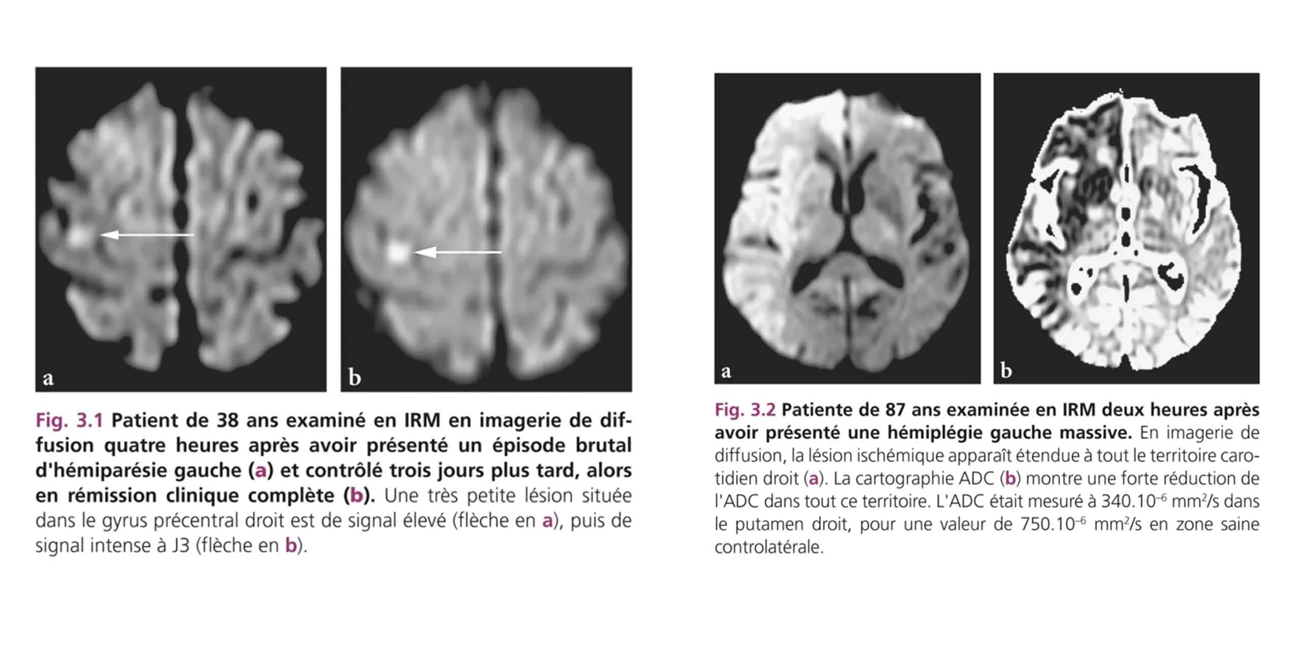 Imageries de diffusion et de perfusion