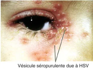 Œil rouge non traumatique