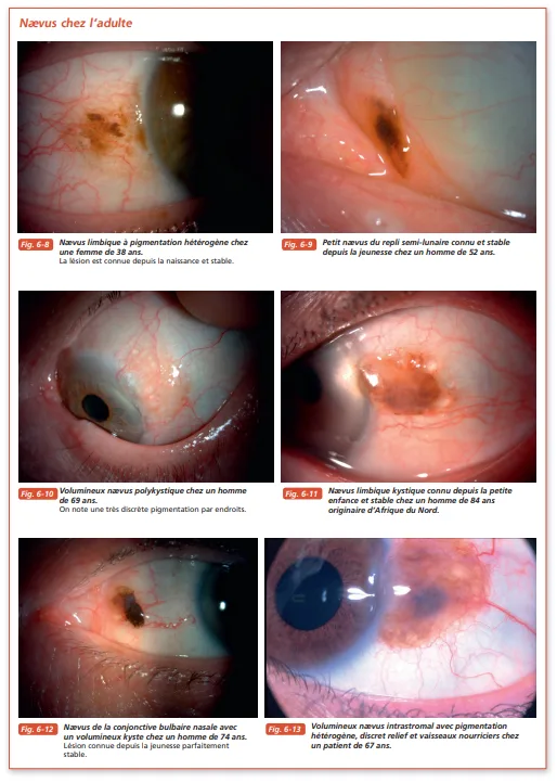 "Nævus oculaire : tumeur fréquente avec architecture limitée et ...