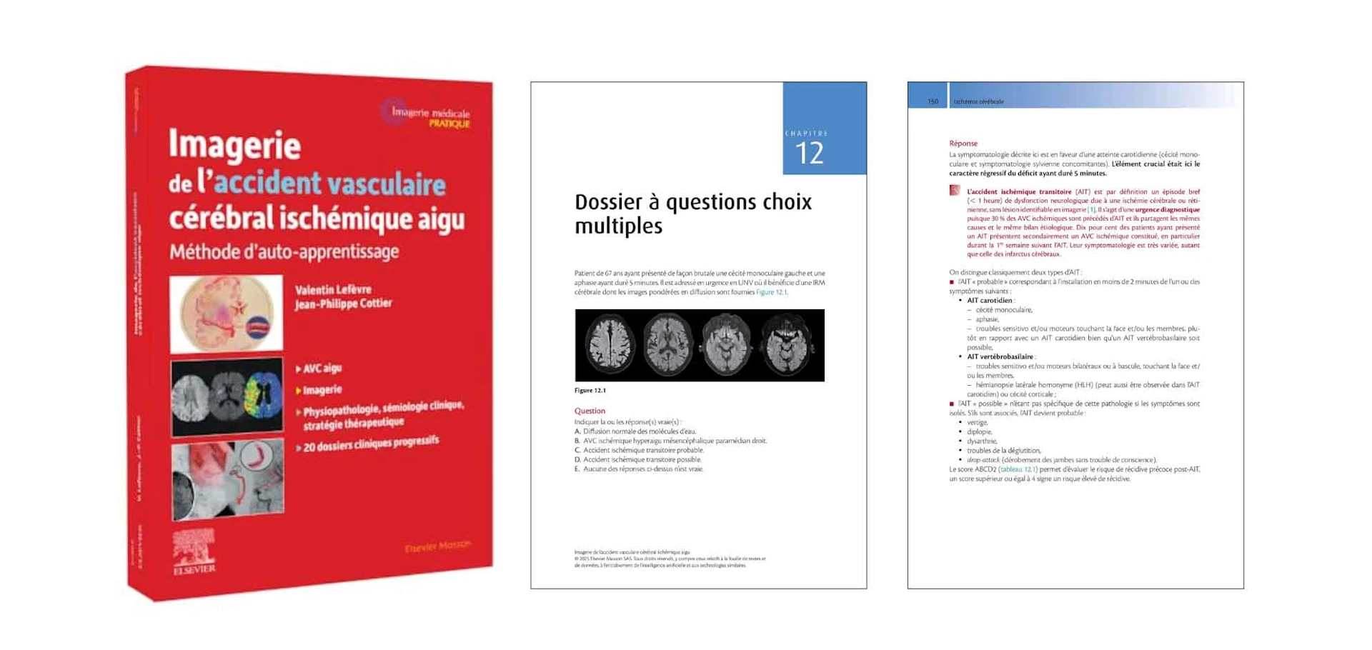 Imagerie de l'accident vasculaire cérébral ischémique aigu. AVC.