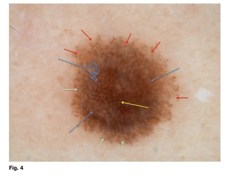 Manuel de dermoscopie