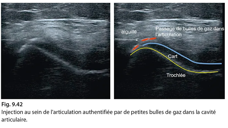 Infiltrations Échoguidées