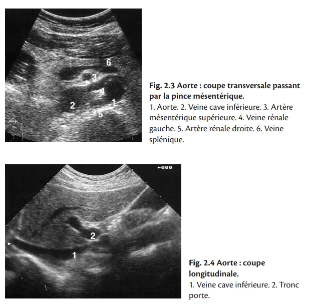 Gros vaisseaux de l'abdomen : échographie