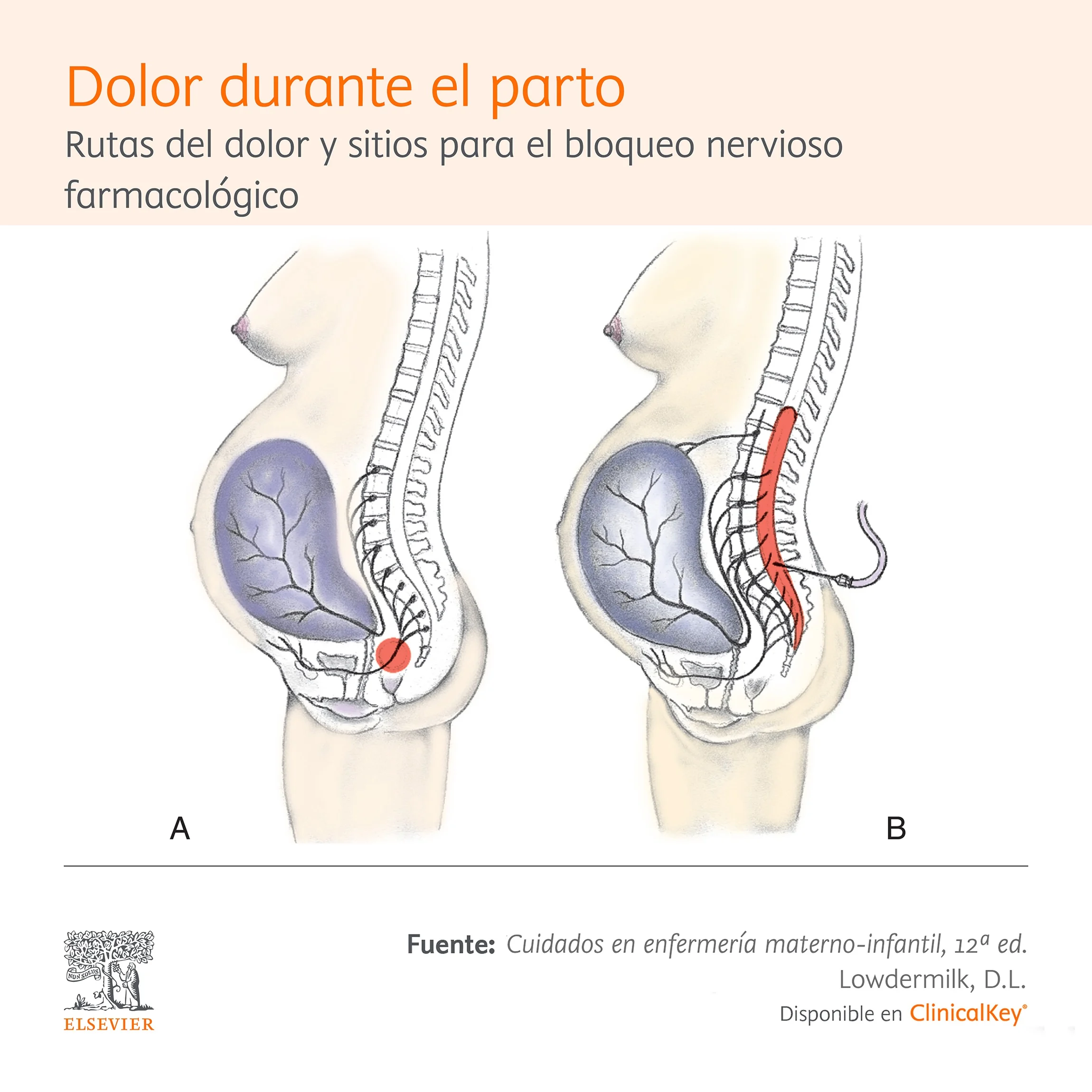 Aumento De La Comodidad De La Mujer Durante El Parto