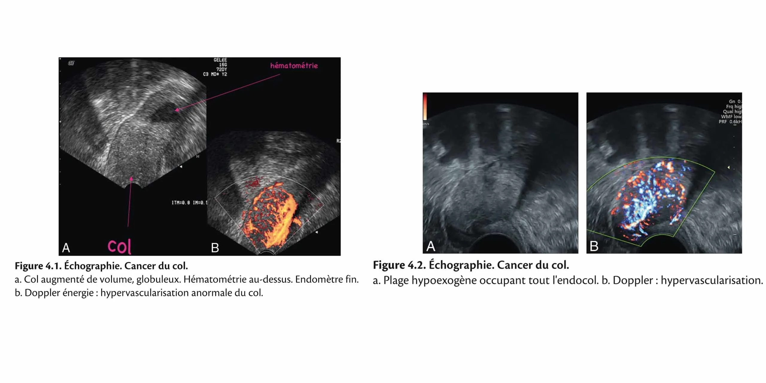 Pathologie du col utérin