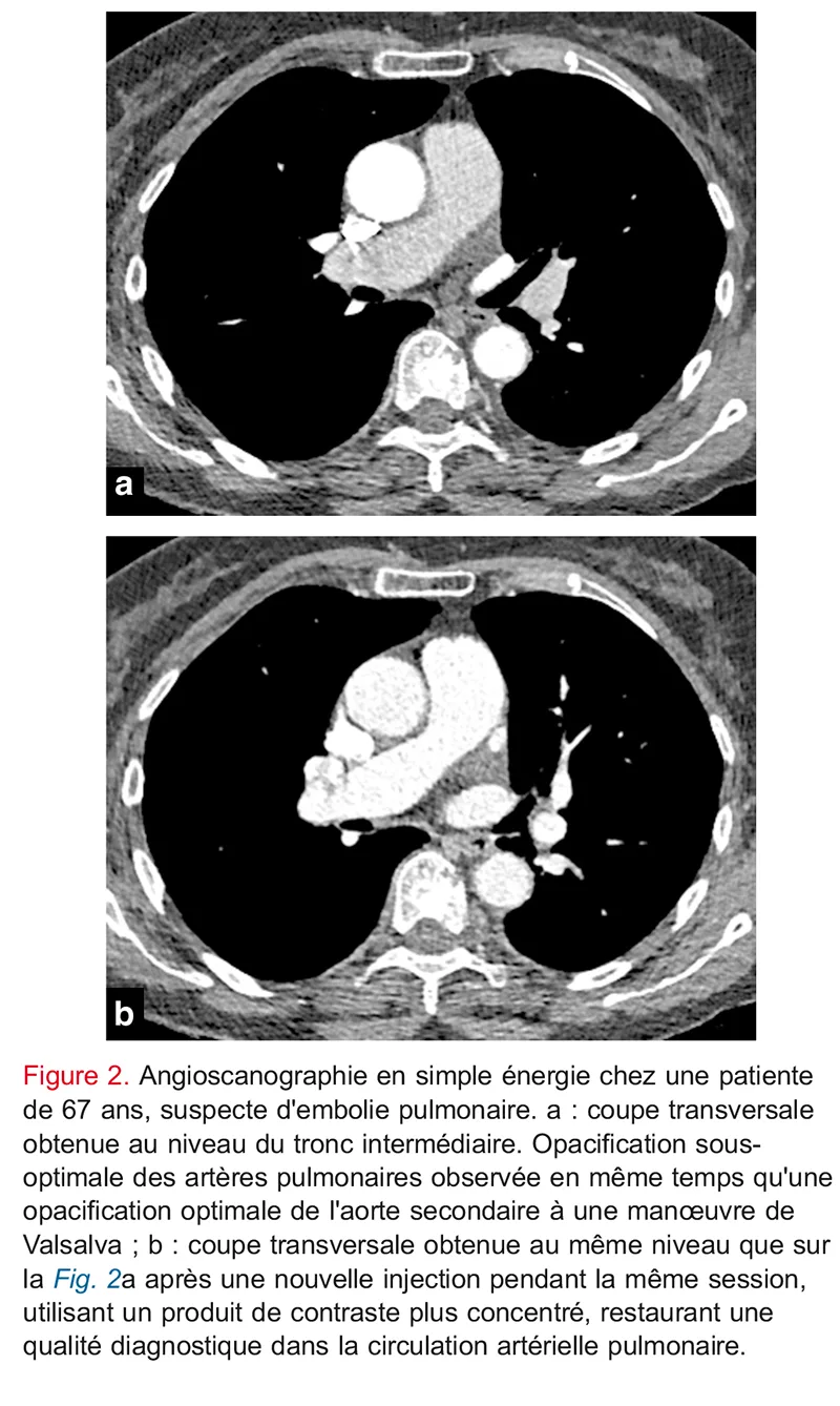 Comment je fais un scanner simple énergie pour embolie pulmonaire aiguë ...