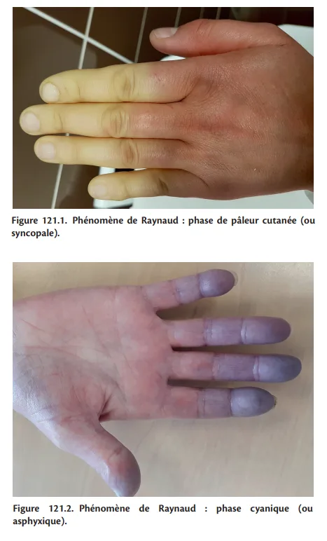 Phénomène de Raynaud