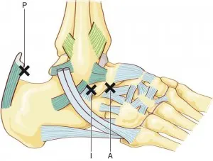 Arthrodèse arthroscopique des articulations tibio-talienne et sous-talienne