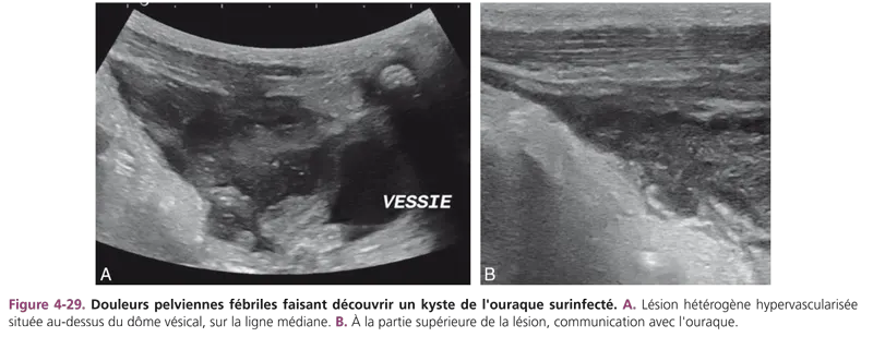 Comment réaliser une Échographie pelvienne de l’enfant et de l ...