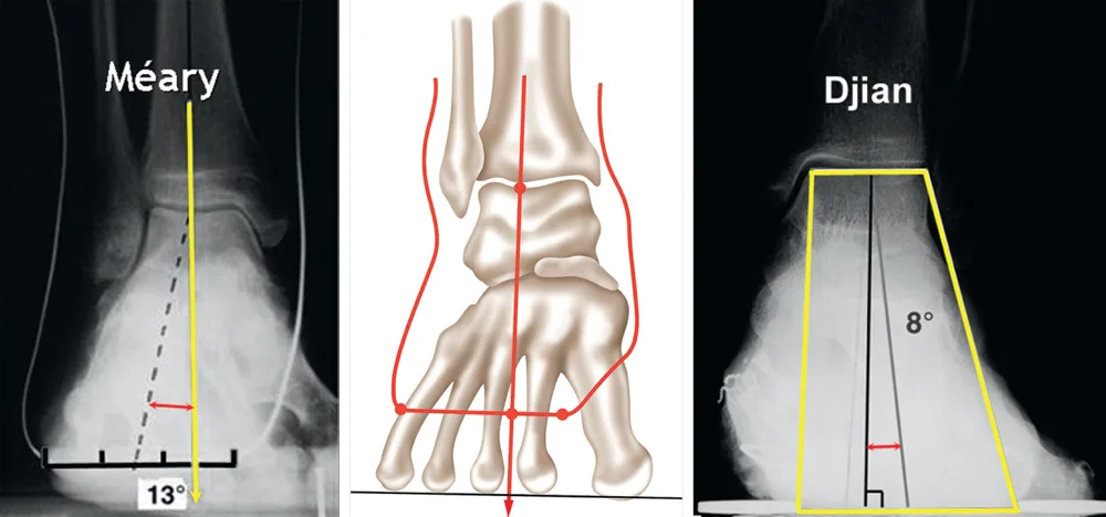 Les techniques de reconstruction du plan capsulo