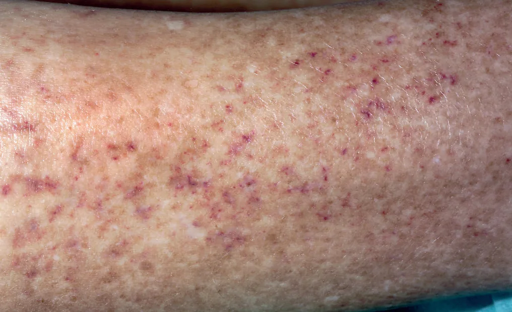 Dermatologie et maladies de la nutrition