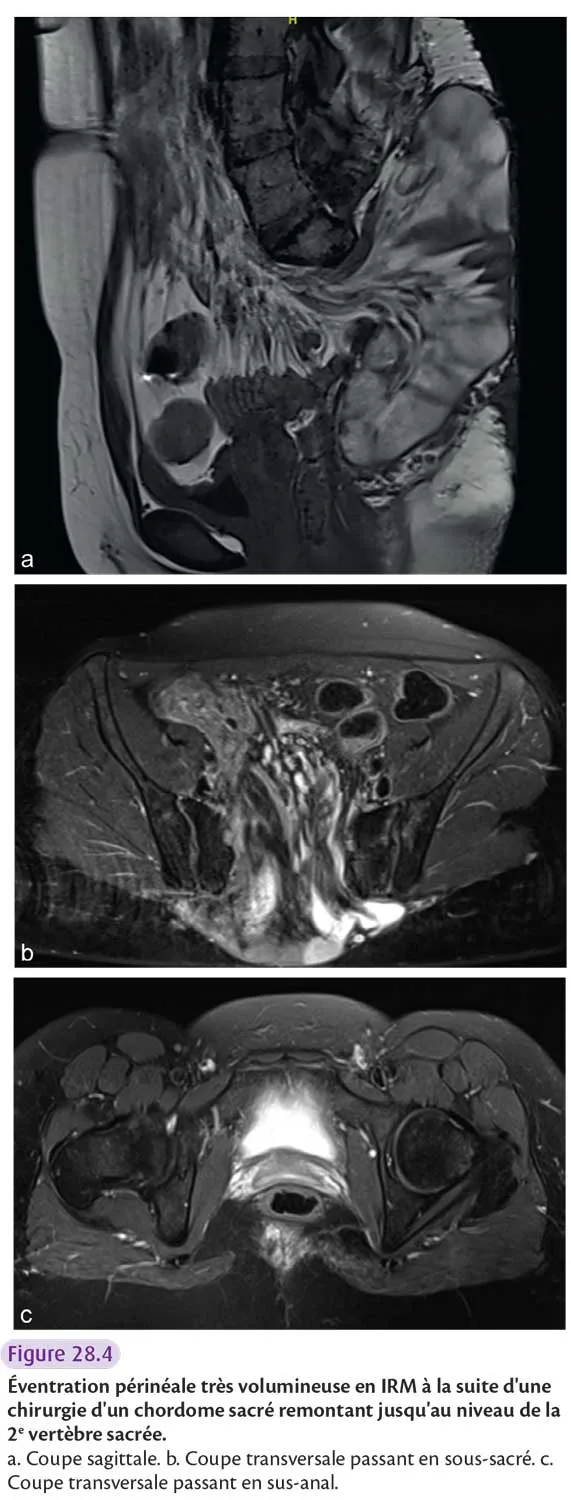 Les pathologies de la paroi abdominale : chirurgie pariétale
