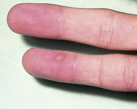 Verrues, un article de l’EMC Savoirs et soins infirmiers