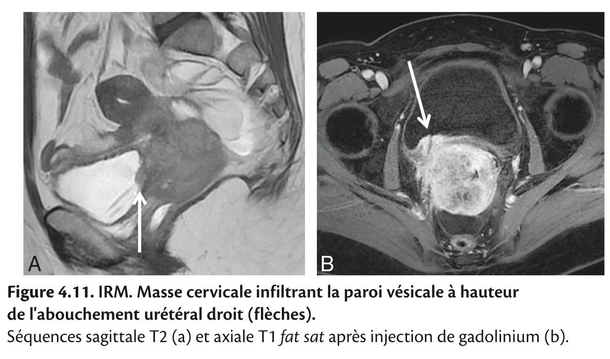 Pathologie du col utérin