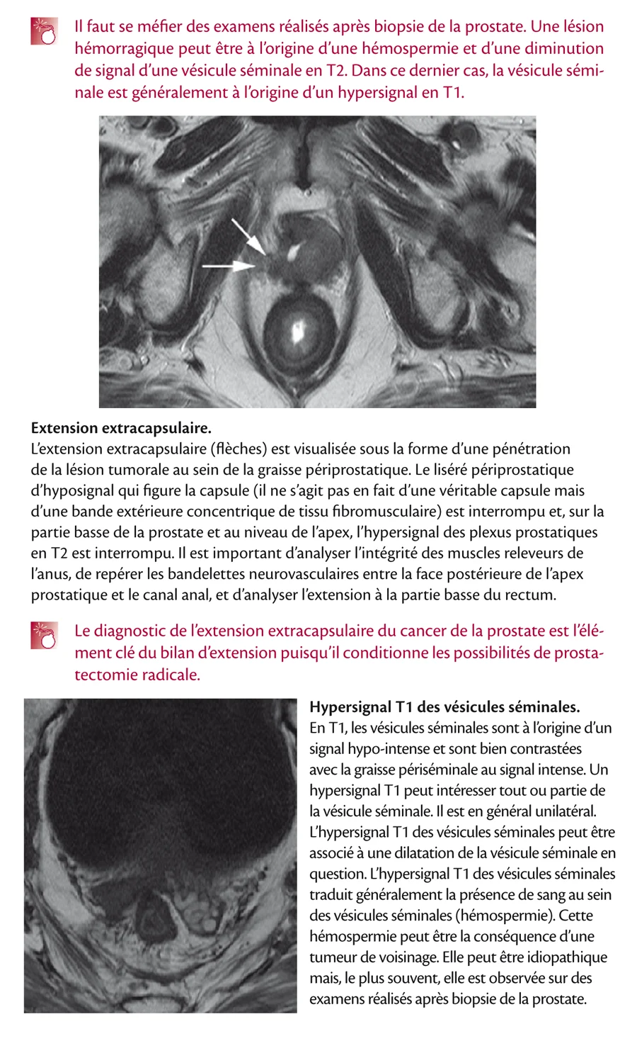 IRM : Cancer de la prostate