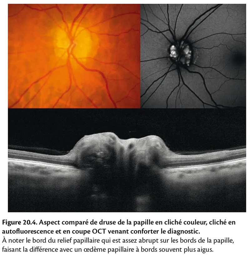 Exploration de la papille par échographie