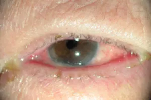 Œil rouge non traumatique