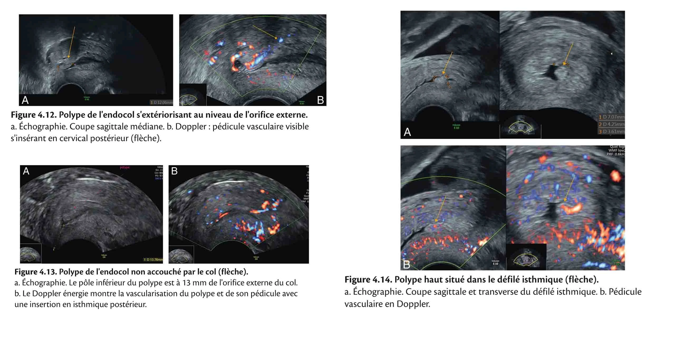 Pathologie du col utérin